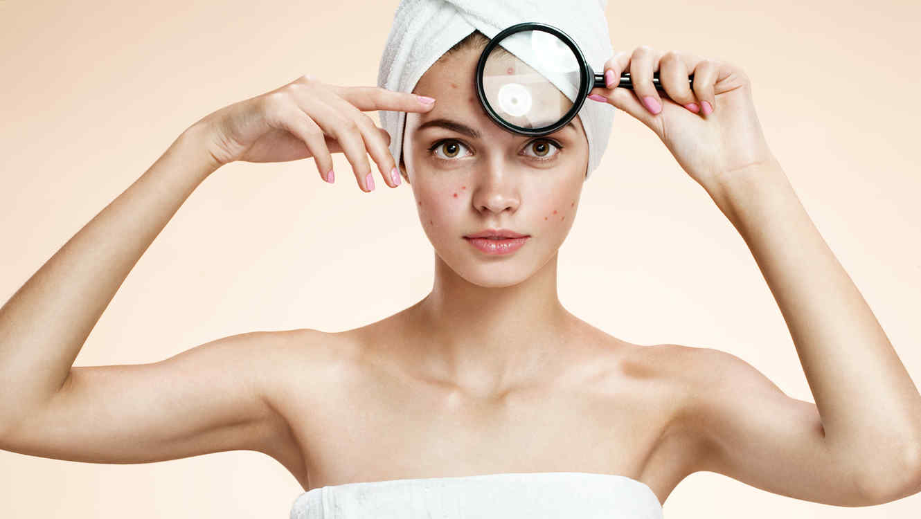 Descubre cuáles son las causas del acné en distintas partes del rostro ...