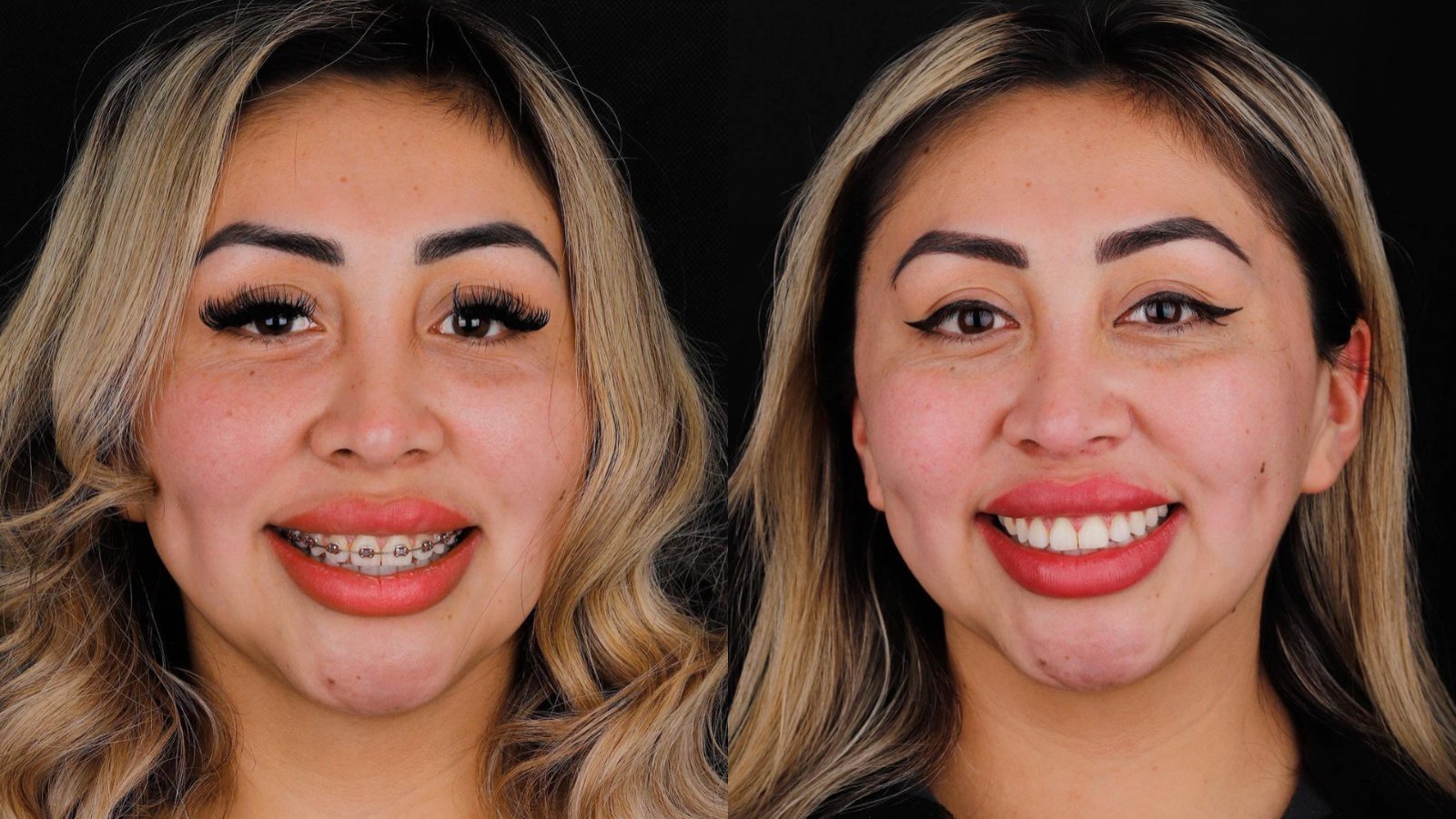 Naya Fácil se sacó los frenillos y presumió su nueva sonrisa